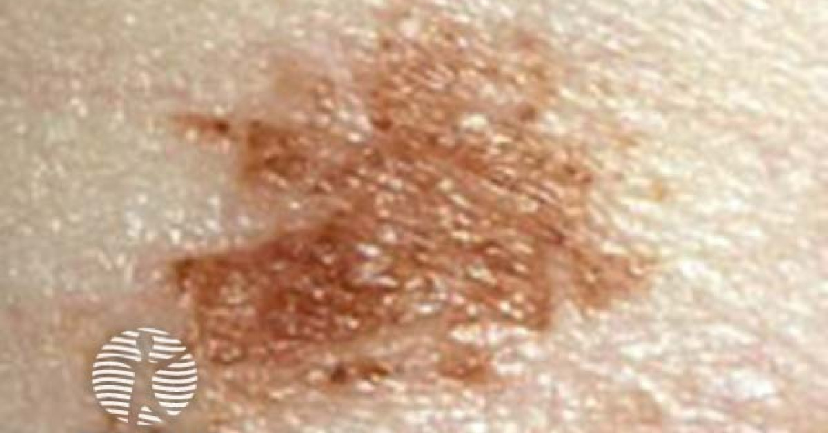 Globular pattern clinical image