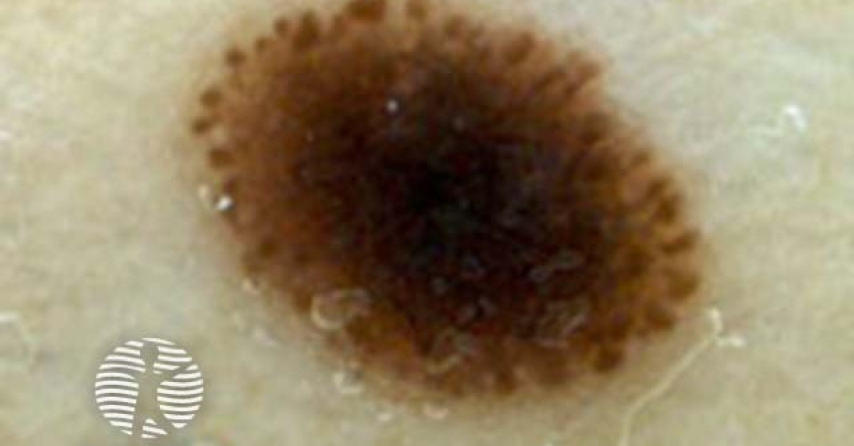 Globular pattern dermoscopy image