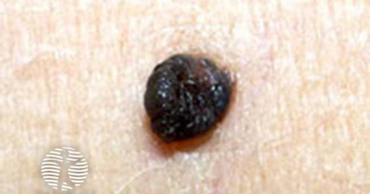 Globular pattern clinical image