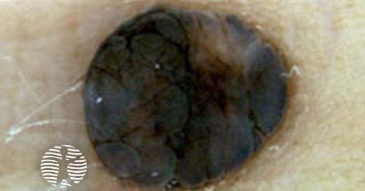 Globular pattern dermoscopy image