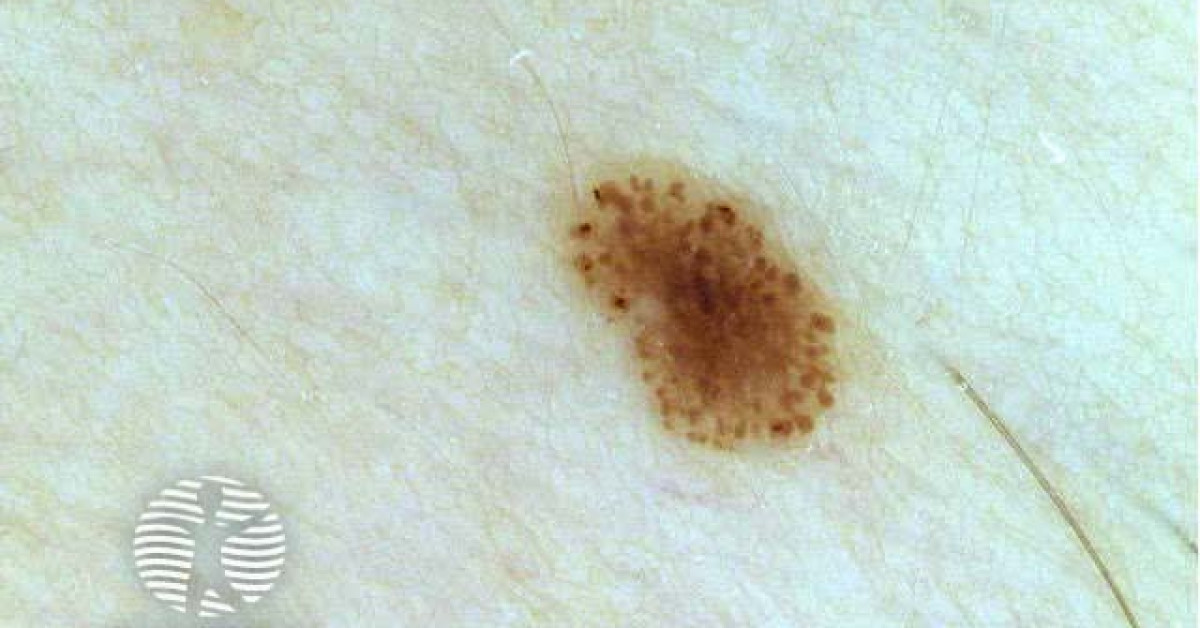 Melanocytic naevus image