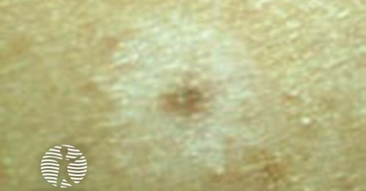 DermNet® - halo naevus dermoscopy image