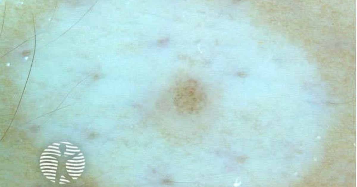 Melanocytic naevus image