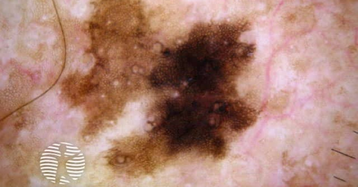 Dermatoscopic image of ink spot lentigo image