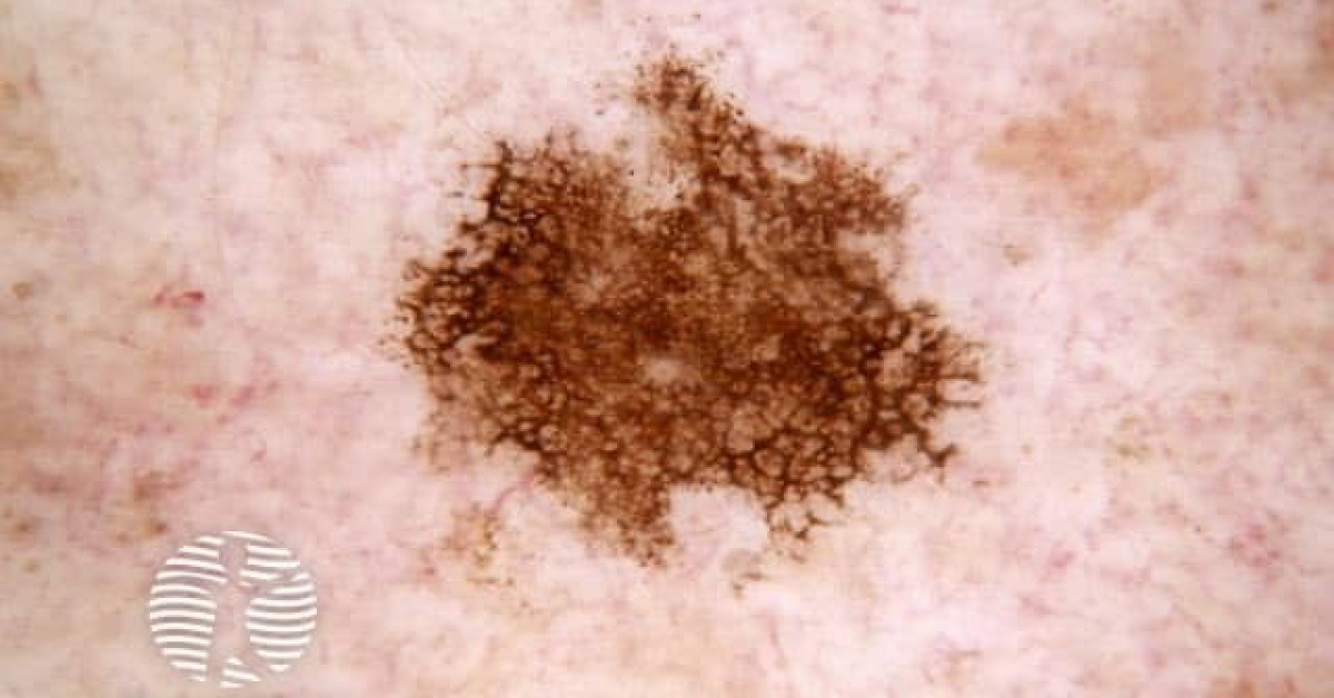 Dermatoscopic image of ink spot lentigo image