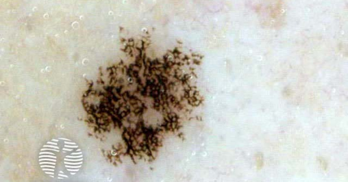 Lentigo simplex image