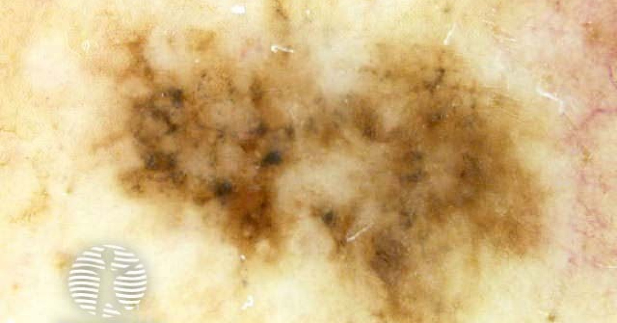 Lentiginous melanoma image