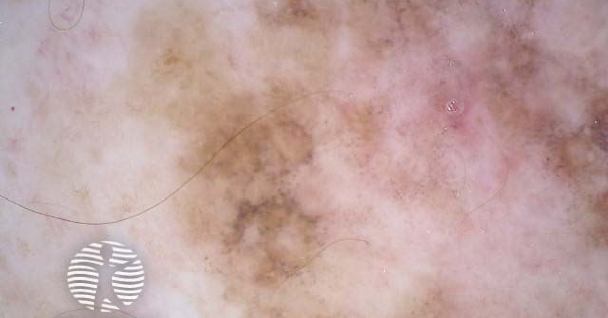 Lentiginous melanoma image