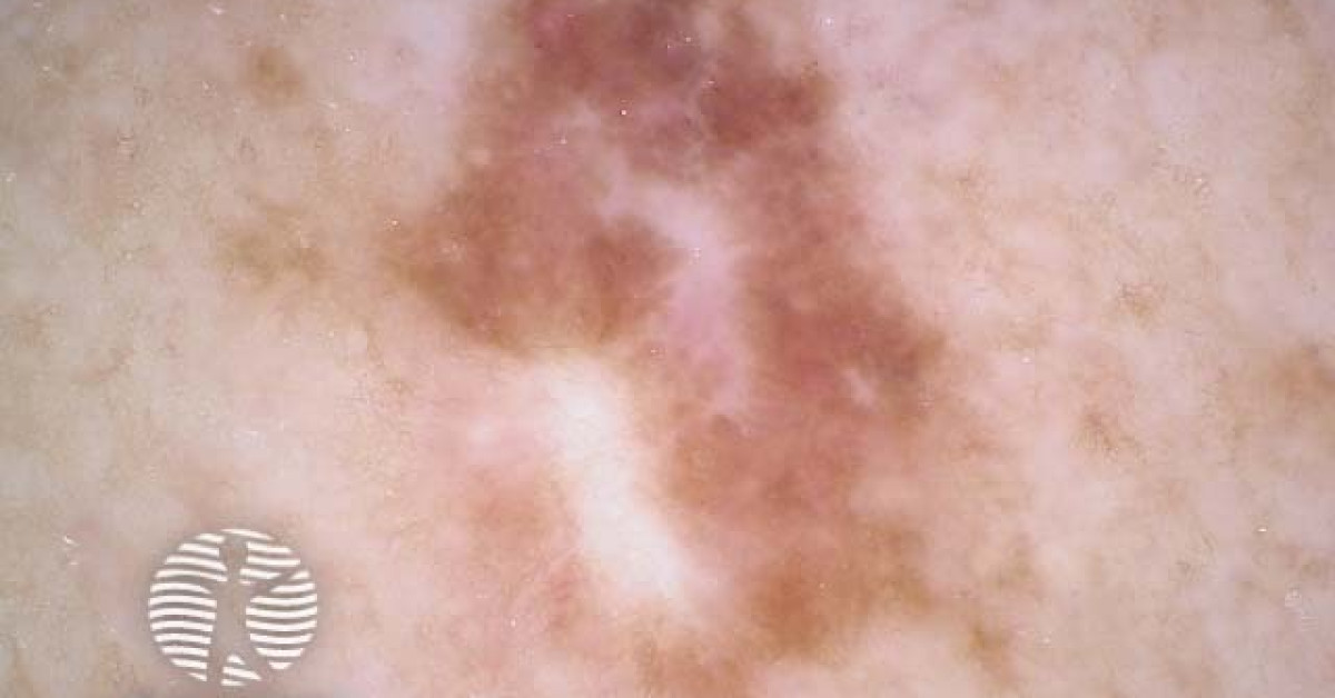 Lentiginous naevus image