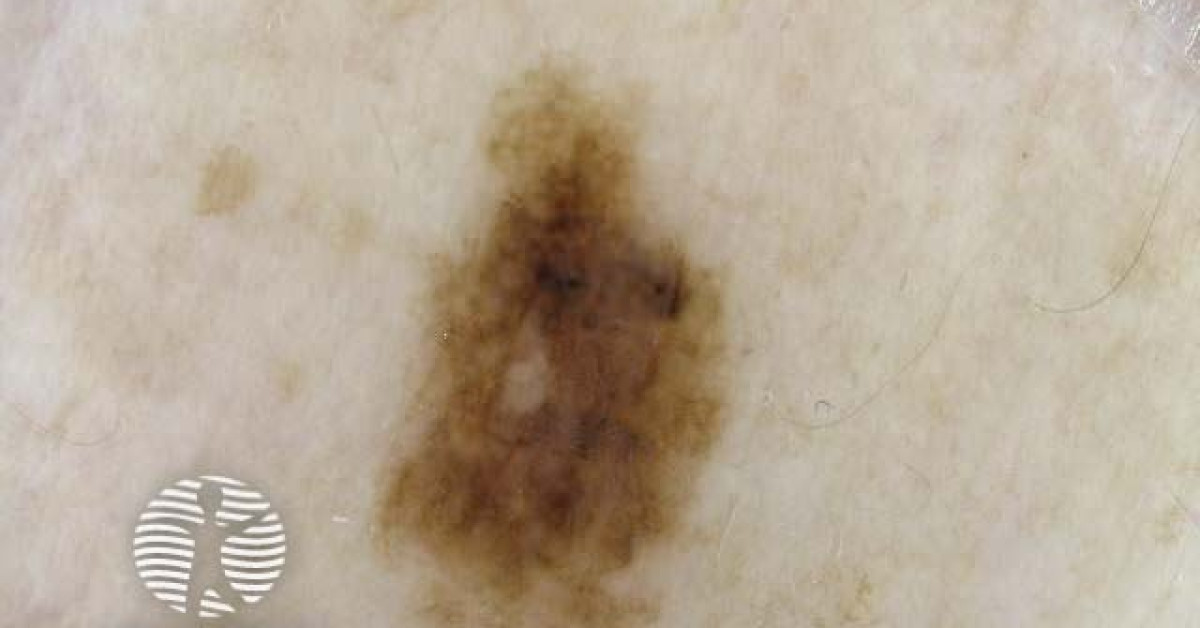 Lentiginous naevus image