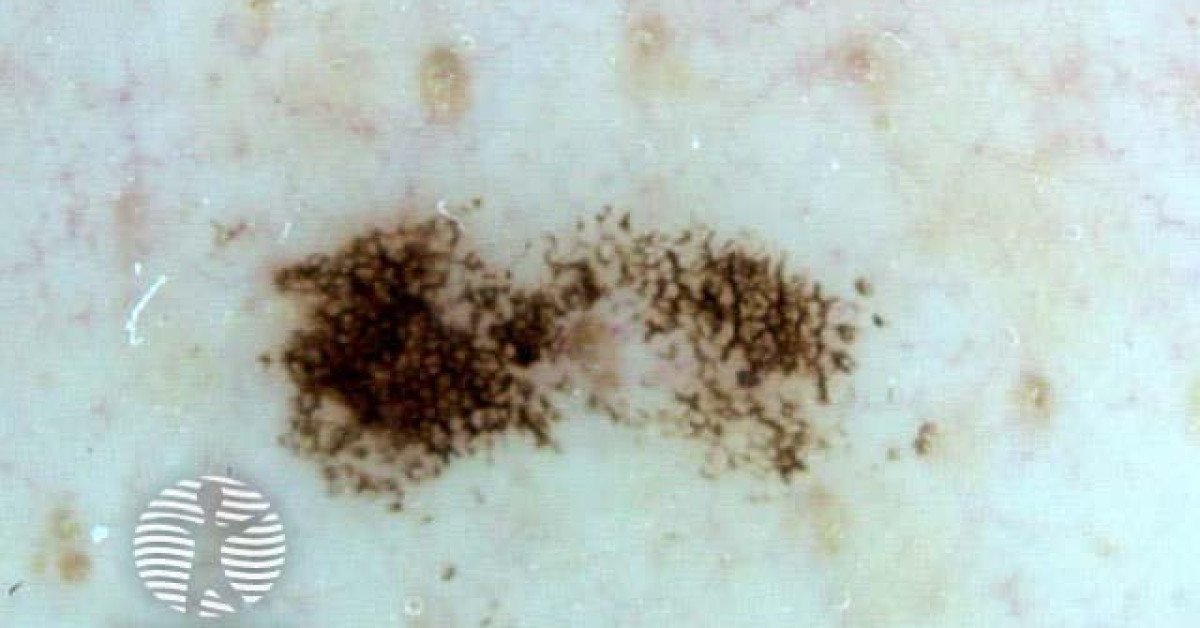 Lentigo simplex image