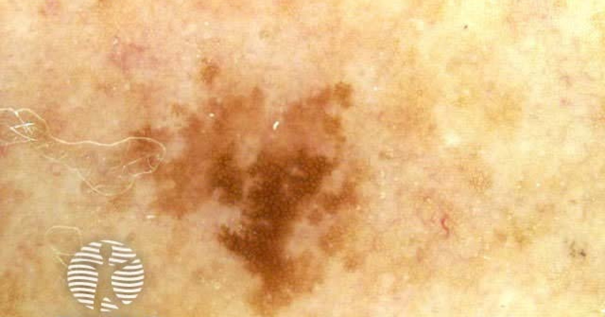 Lentigo simplex image