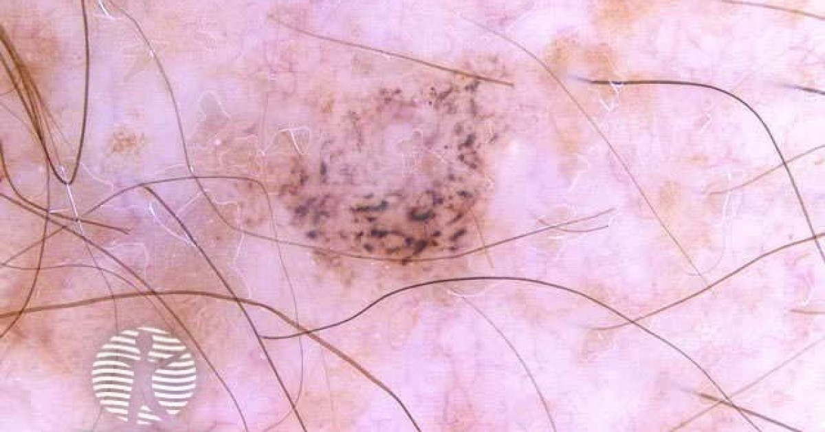 Dermoscopy image