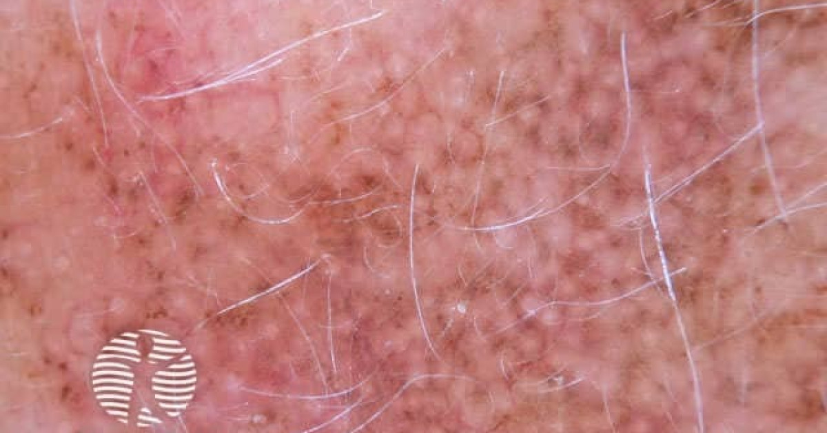 Annular granular pattern seen in dermoscopy of lentigo maligna image