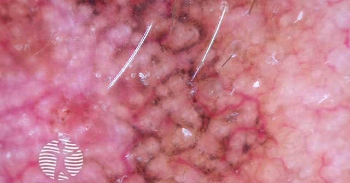 Annular granular pattern and rhomboids seen in dermoscopy of lentigo ...