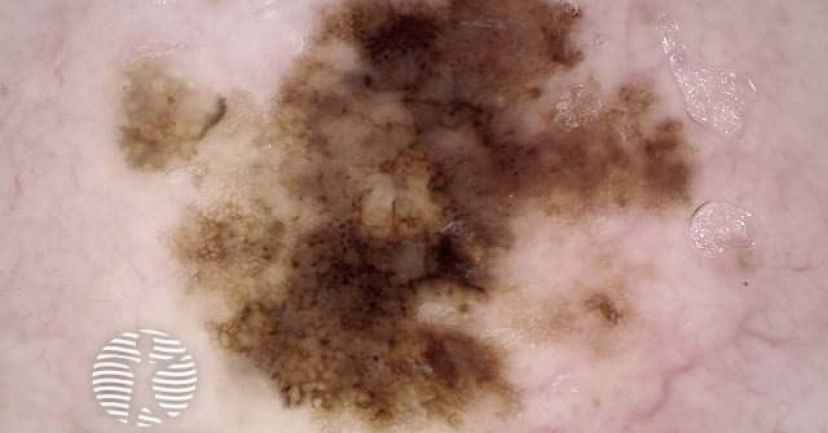 Dermatoscopy of melanoma with thick lines image