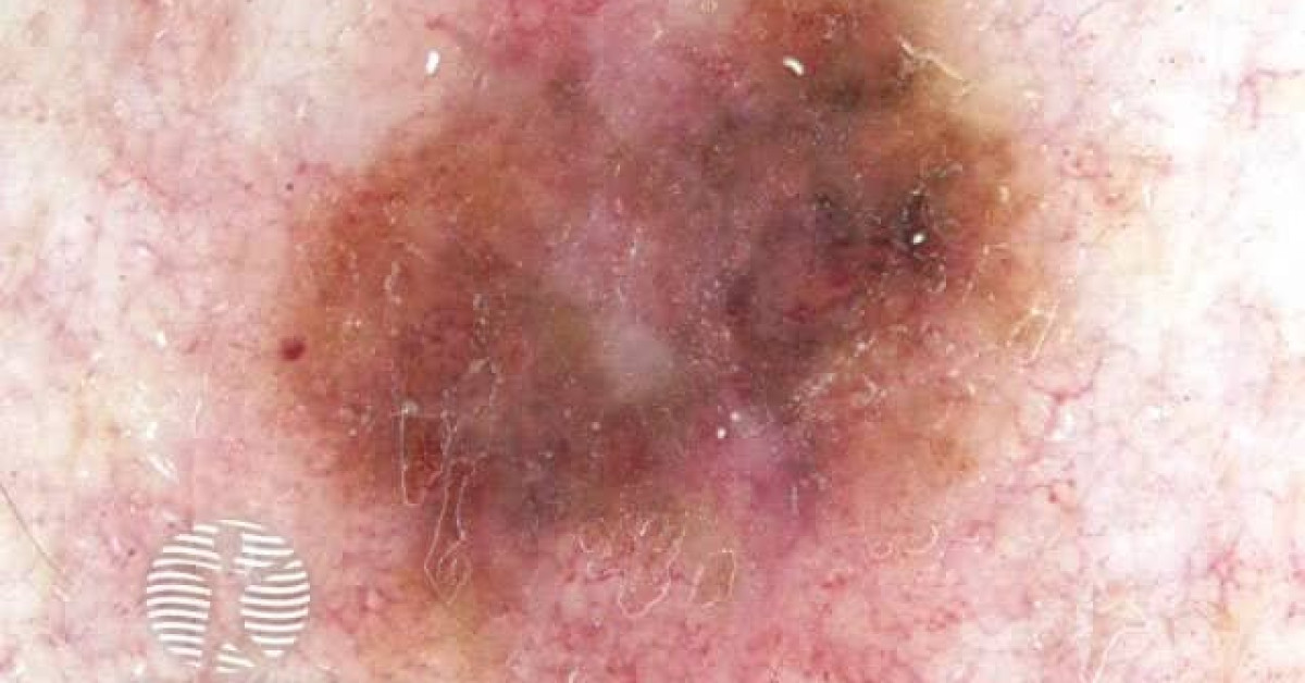 Dermoscopy image