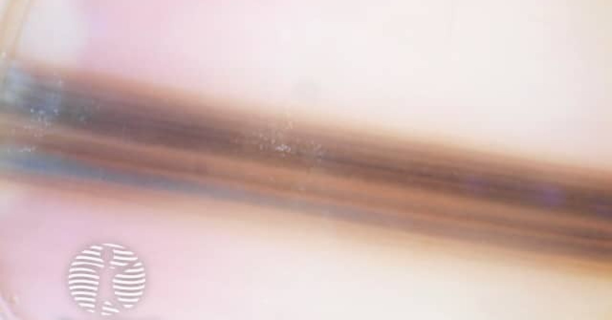 Dermatoscopy of nail matrix melanoma image