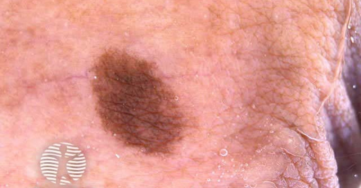 Mucosal melanosis image