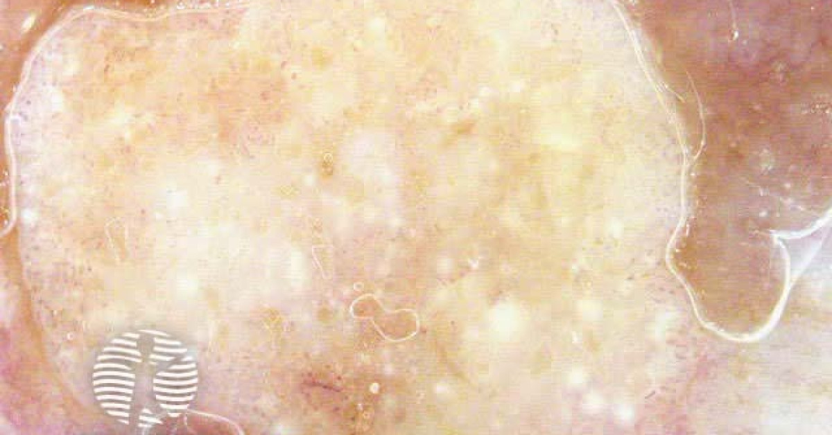 DermNet® - Dermoscopy image