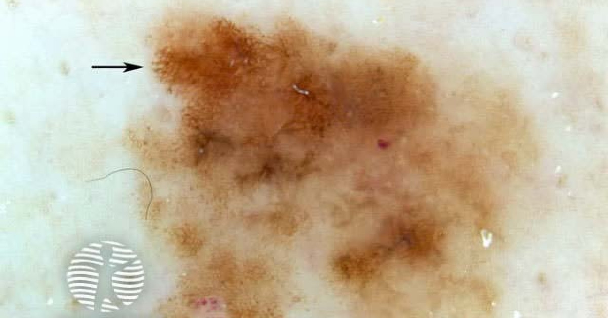 Melanoma image