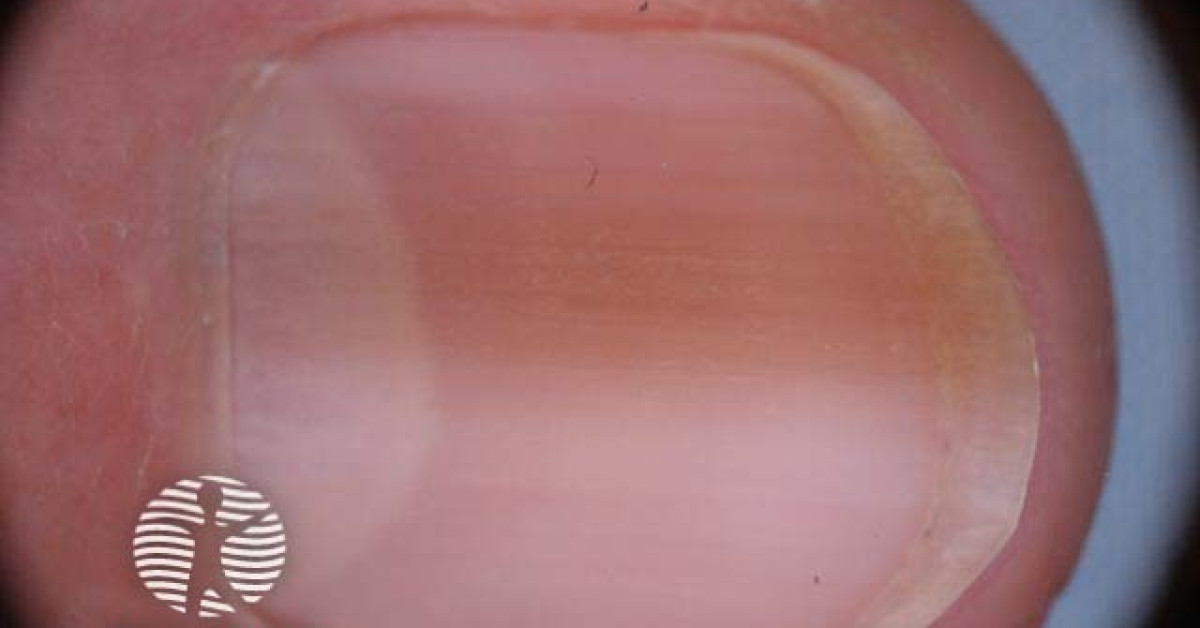 DermNet® - Dermoscopy image