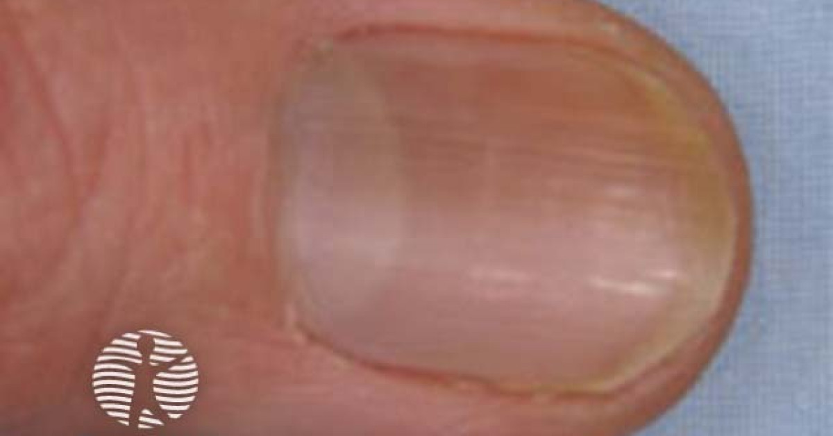 Nail naevus clinical image