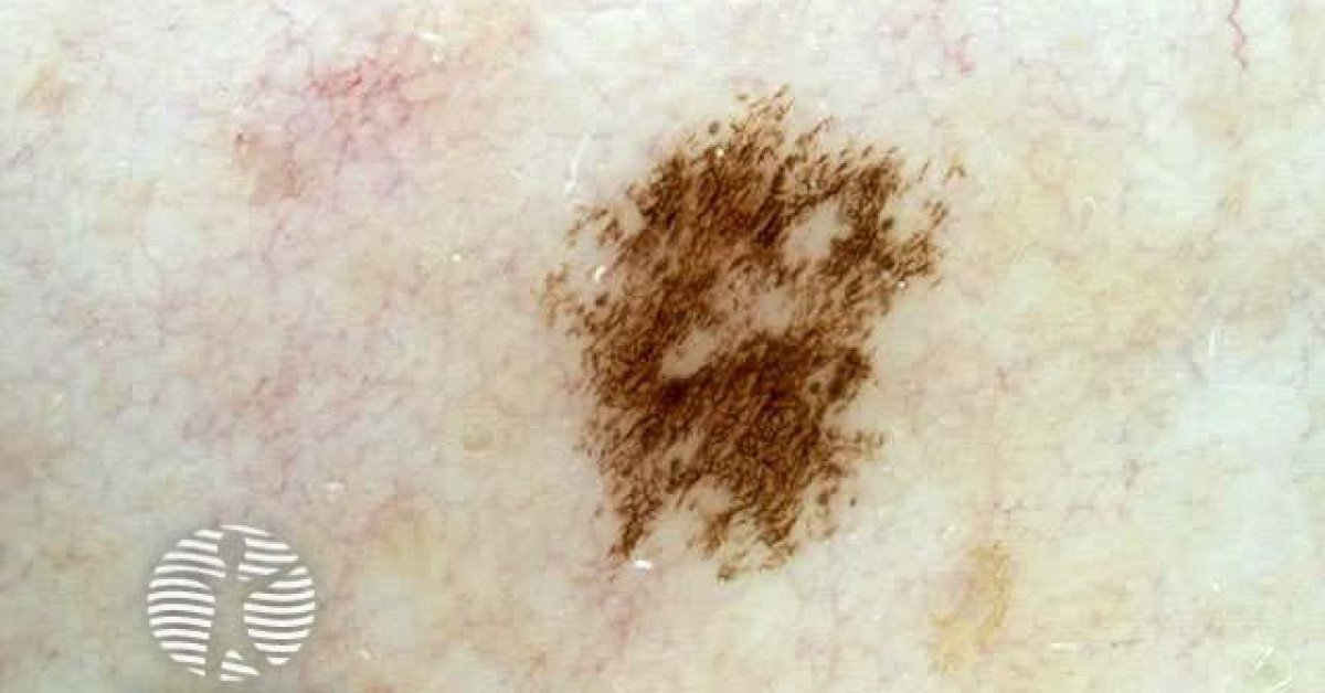 Lentigo simplex image