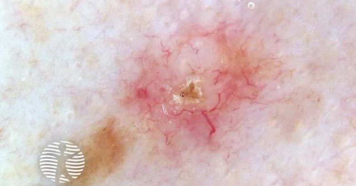 Nonpigmented basal cell carcinoma dermoscopy image