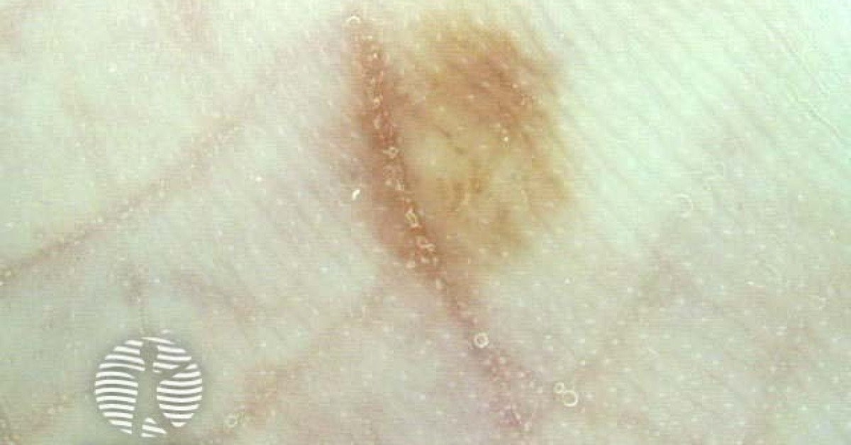 Melanocytic naevus image