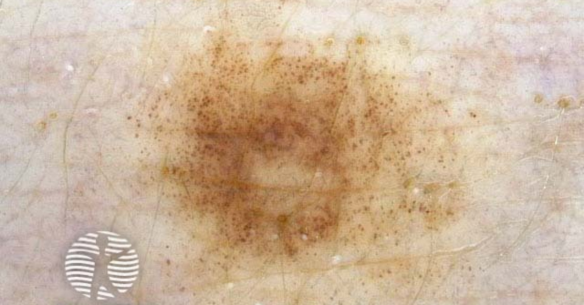 Melanocytic naevus image