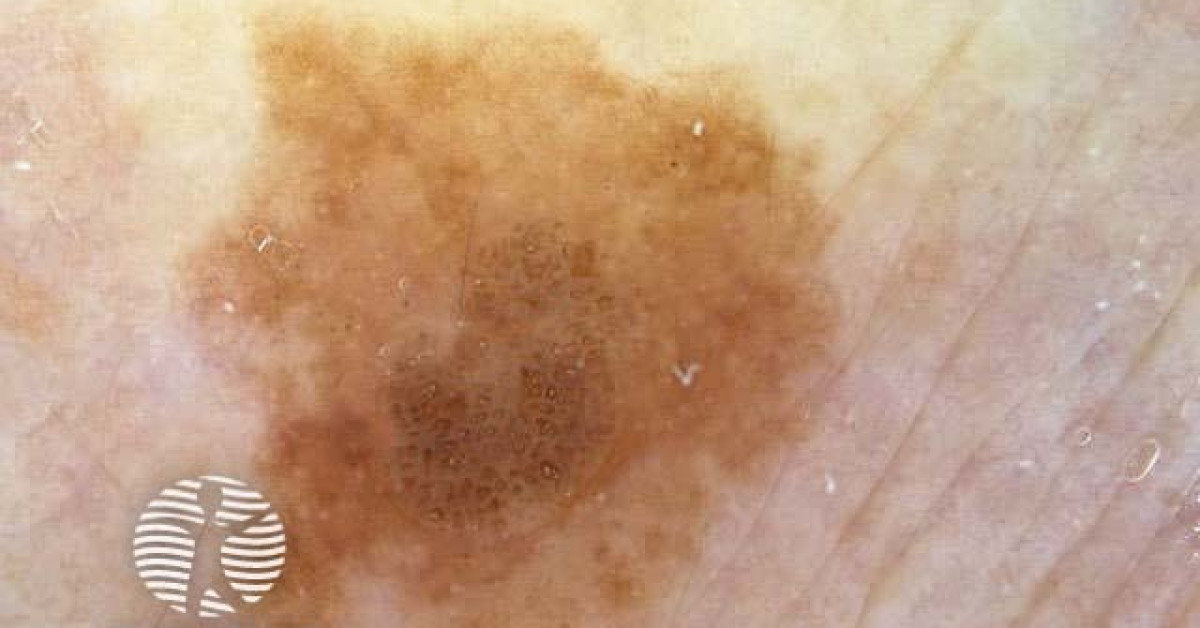 DermNet® - Dermoscopy image