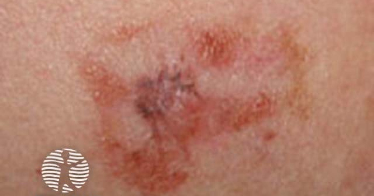 Recurrent naevus clinical image