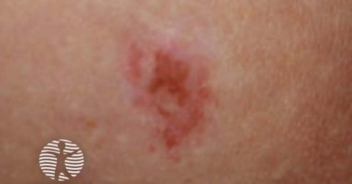 Recurrent naevus clinical image