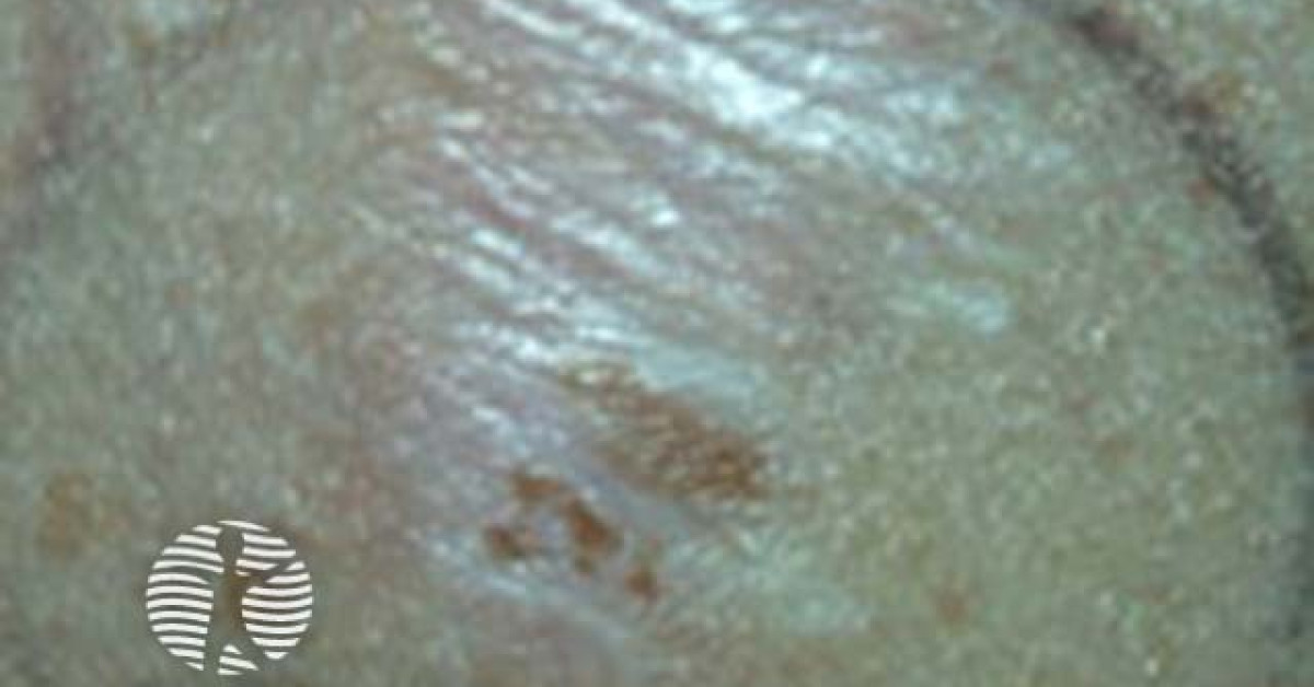 Recurrent naevus clinical image