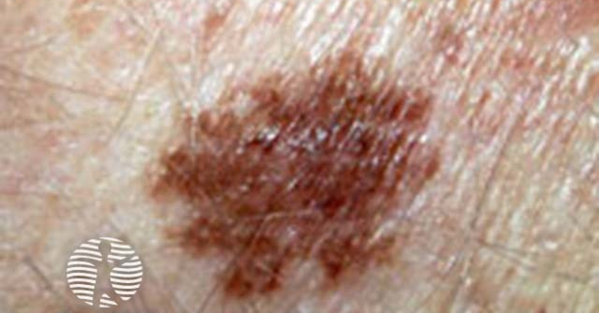 Reticular Pattern Clinical Image