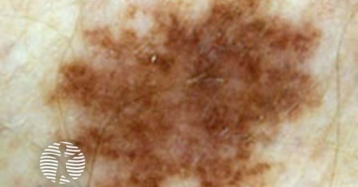 Reticular pattern dermoscopy image