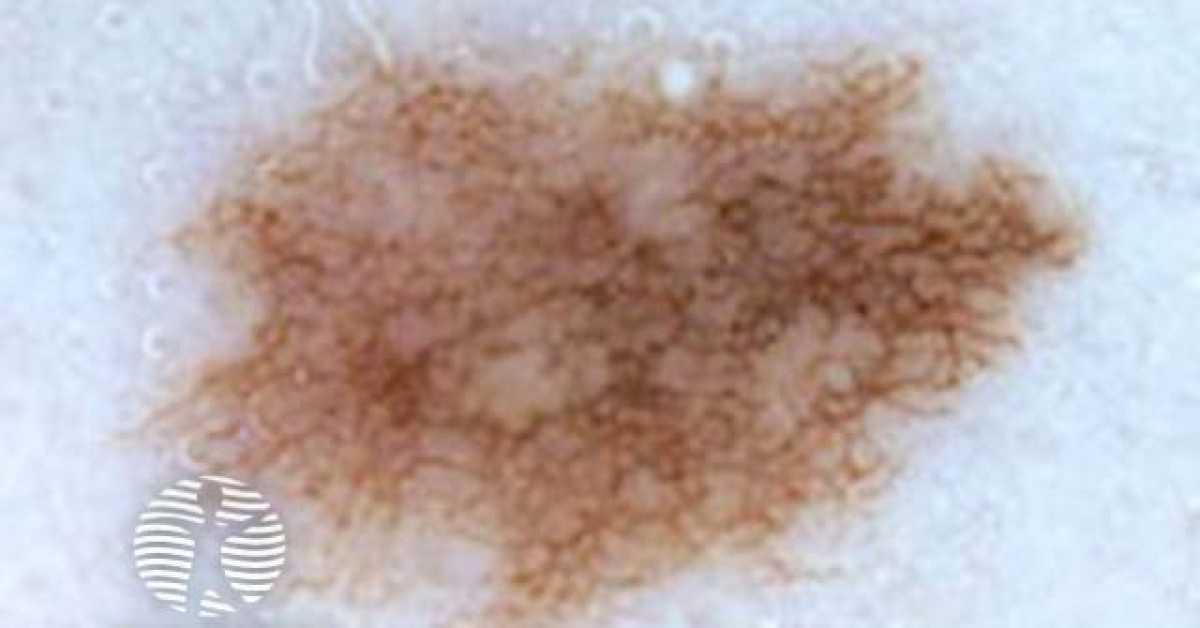 Reticular pattern dermoscopy image