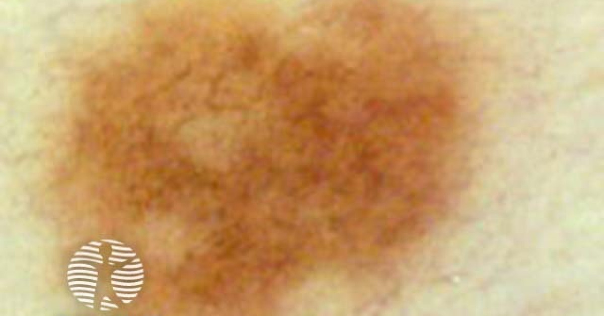 Dermnet® Reticular Pattern Dermoscopy Image