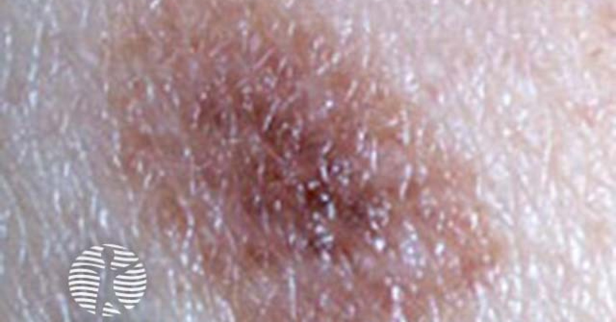 Reticular pattern clinical image