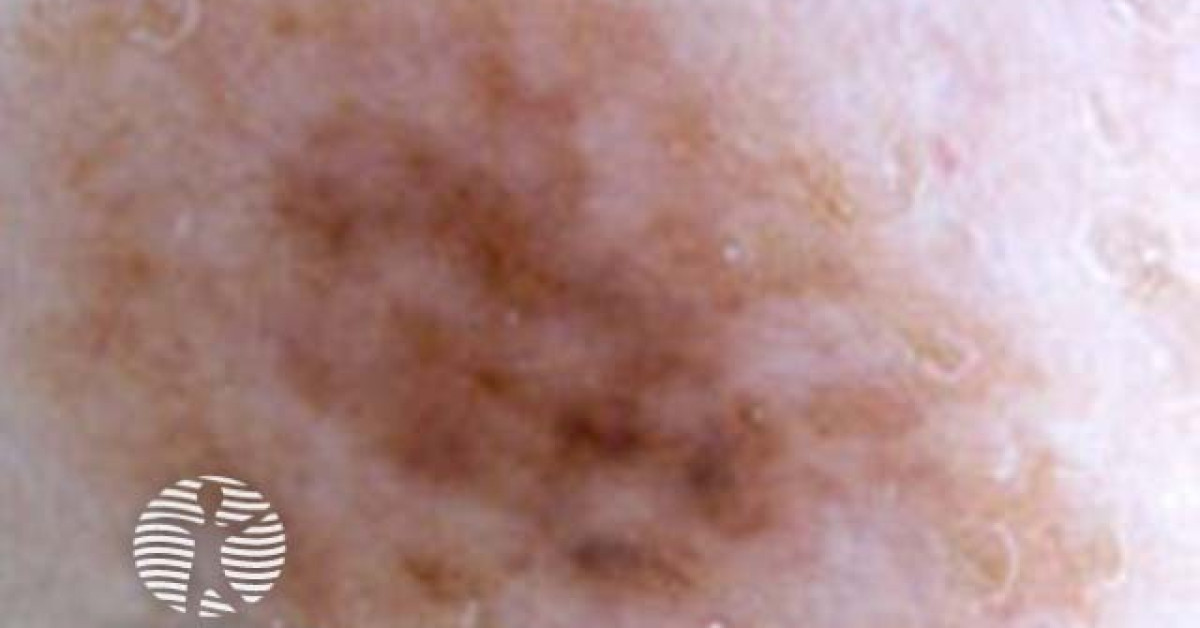 Reticular pattern dermoscopy image