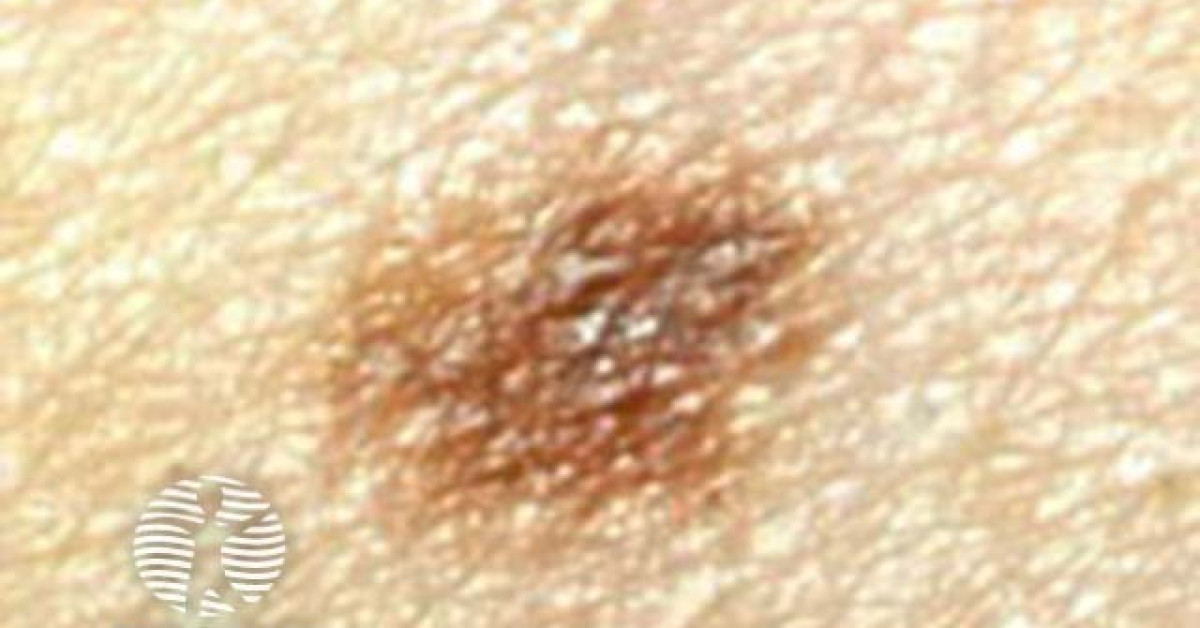 Reticular Pattern Clinical Image