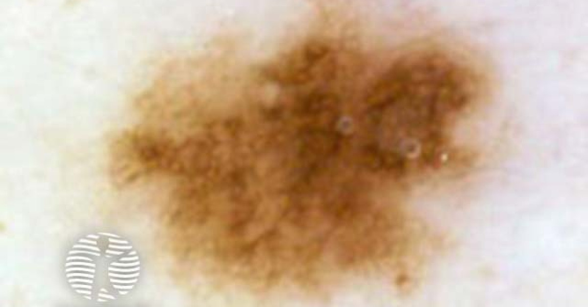 Reticular pattern dermoscopy image