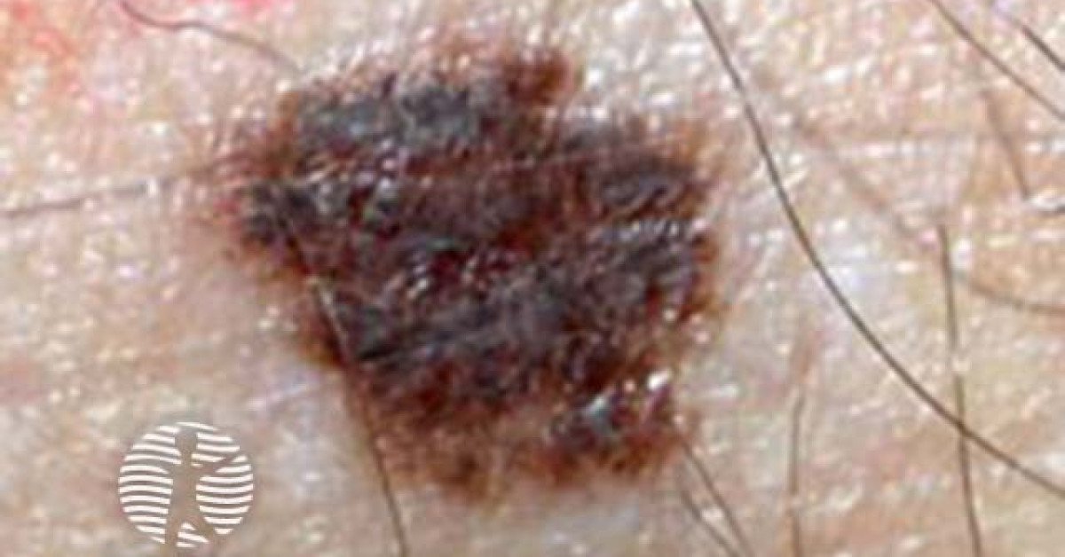 Reticular pattern clinical image