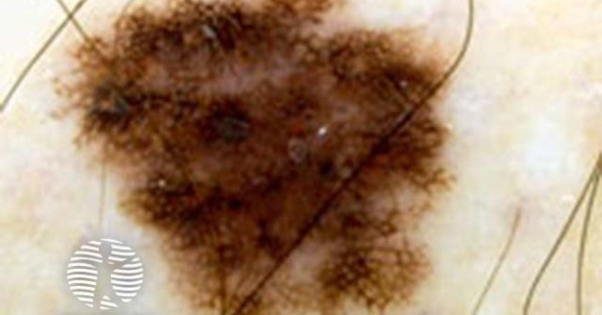 Reticular pattern dermoscopy image