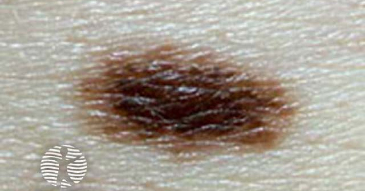 Reticular pattern clinical image