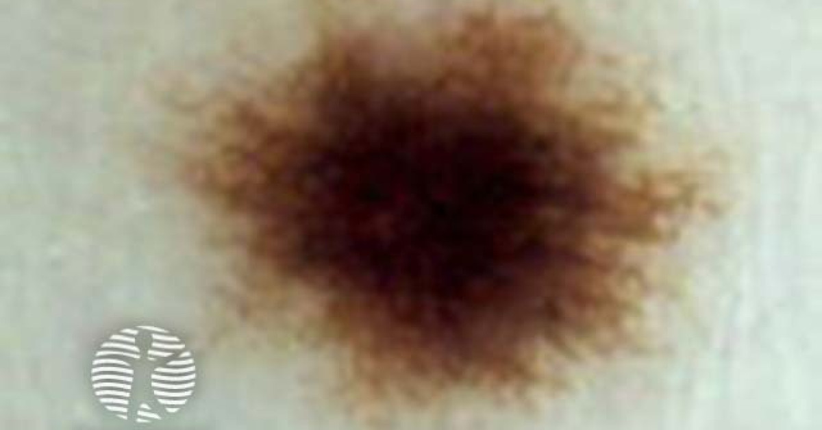 Reticular Pattern Dermoscopy Image