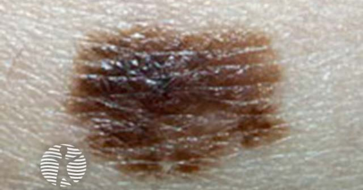 Reticular Pattern Clinical Image