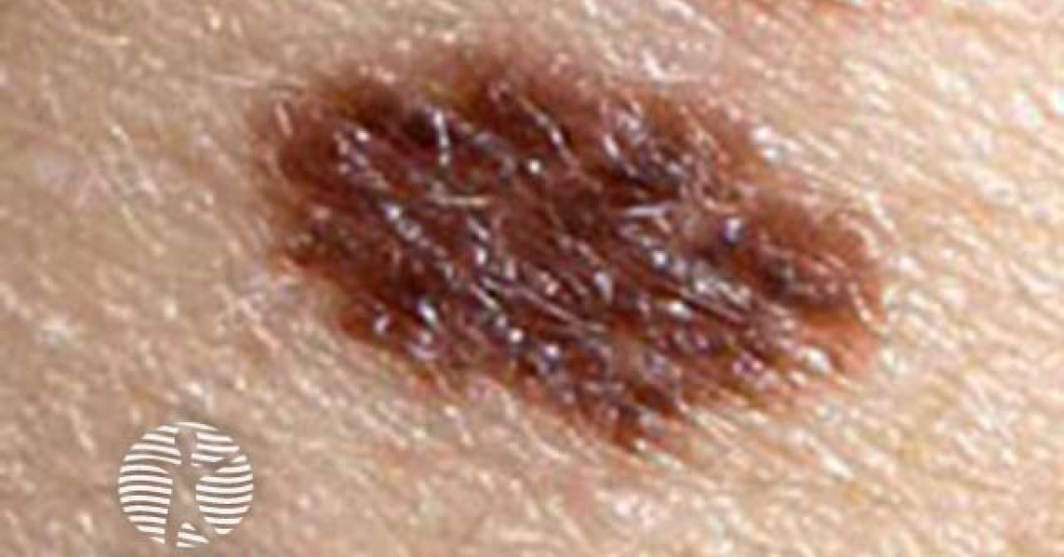 Reticular pattern clinical image