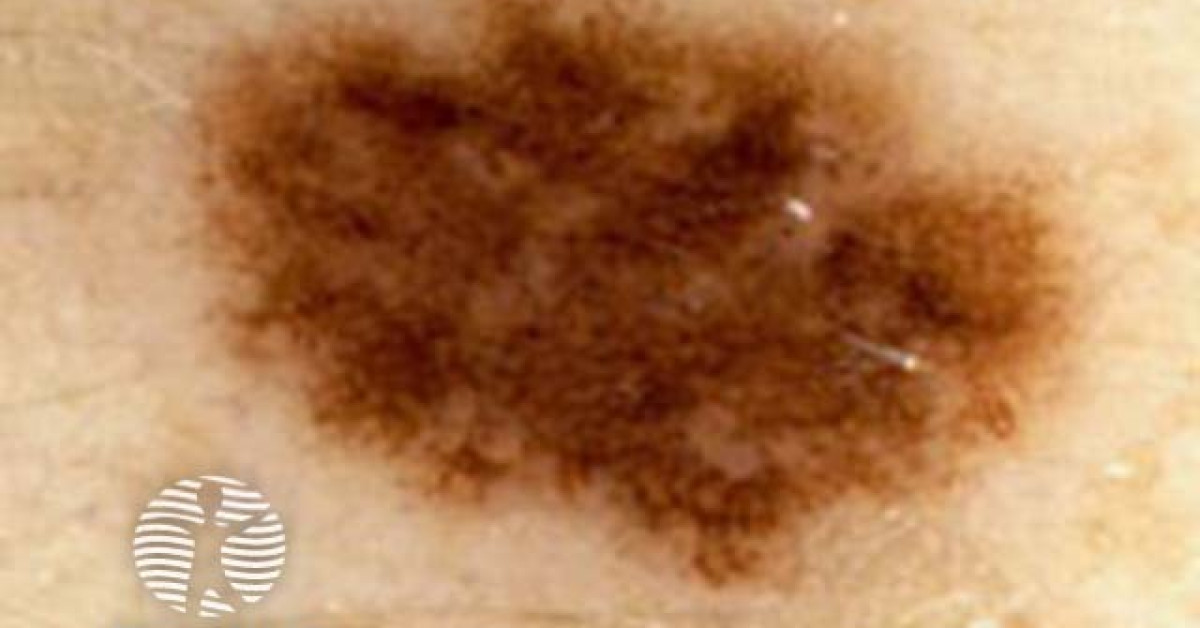 Reticular pattern dermoscopy image